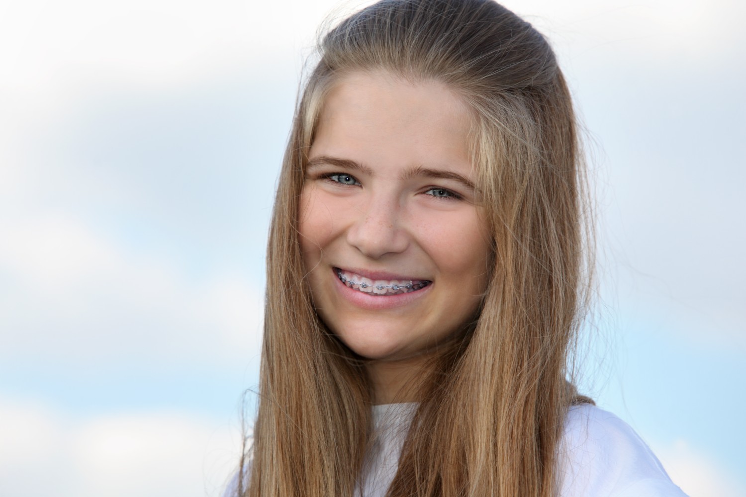 Two-Phase Treatment | Myrtle Beach Braces | Seabreeze Orthodontics